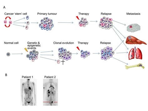 Tumour Heterogeneity A Recent Molecular And Genetic Profiling Has