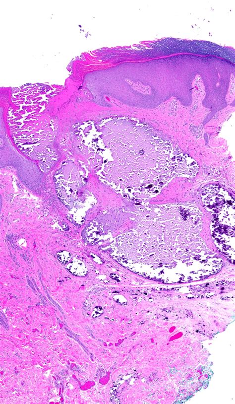 Calcinosis Cutis Histopathology A Rare Case Of Calcinosis Cutis