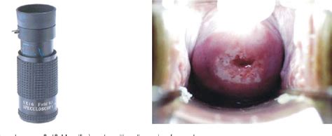 Figure 2 From Papsure Test For Cervical Cancer Screening Papanicolaou