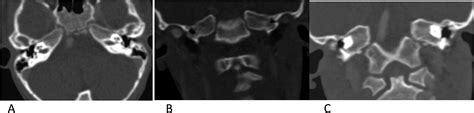 Agenesis Of The Internal Carotid Artery Pacs