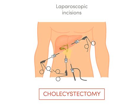 Gallbladder Surgery Tijuana Surgery Center