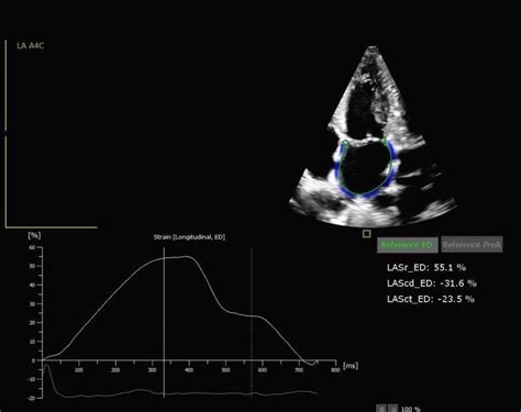 Evaluation Of Left Atrial Strain Using Speckle Tracking