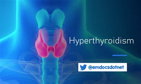 Hyperthyroidism Ed Presentations Evaluation And Management Emdocs