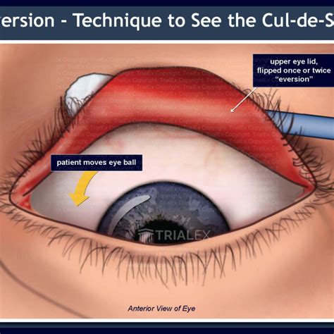 Medical Legal Exhibits Legal Animations And Trial Graphics