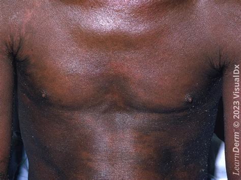 Erythroderma Learnderm