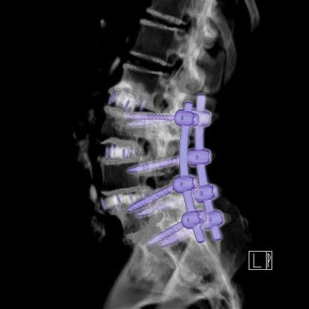 L4 L5 Back Fusion