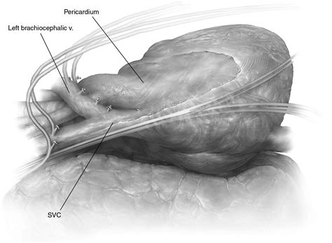 Thymectomy Surgery Video At William Wickens Blog