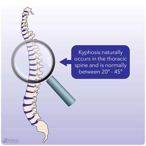 Kyphosis And Hyperkyphosis What It Is How It Happens And What To Do