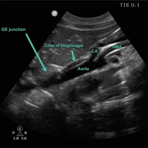 Focused Assessment With Sonography For Trauma Abdominal Aortic