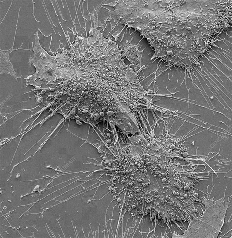 Bone Cancer Cells Sem Stock Image F043 9933 Science Photo Library