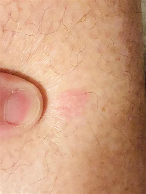 Ringworm Raskdoctorsmeeee