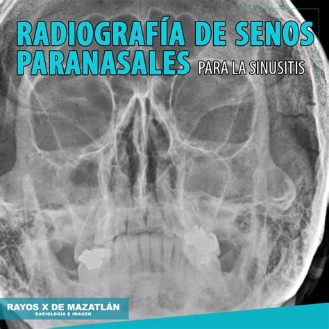 Radiografía De Los Senos Paranasales La Radiografía De Waters Es La