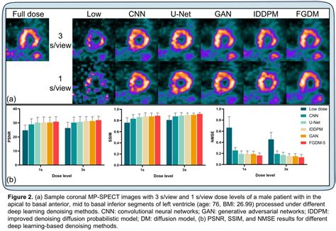 Low Dose Myocardial Perfusion Spect Denoising Using A Fast Generalized Diffusion Model Journal