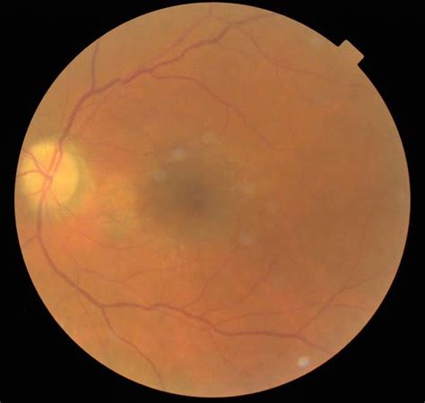 An Enlarging Conjunctival Lesion On A Teenager Box Hill Eye Surgeons