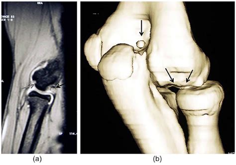 Osteochondritis Dissecans Of Smaller Joints The Elbow Juergen Bruns