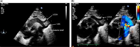 Echocardiography Of Coarctation Of The Aorta Aortic Arch Hypoplasia And Arch Interruption