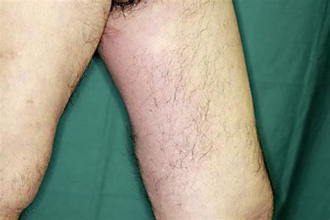 Clinical Appearance Of Cellulitis On The Right Thigh Download Scientific Diagram