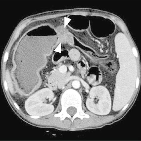 Colonoscopic Finding 15 Cm Sized Isp Semipedunculated Type Polyp At