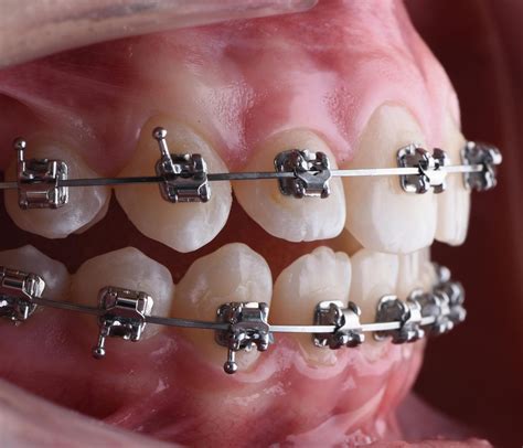 Ortodoncia Brackets Cco System En Valledupar Dr Maya