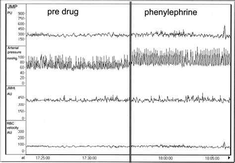 An Individual Recording Of Jejunal Mucosal Perfusion Jmp Jejunal