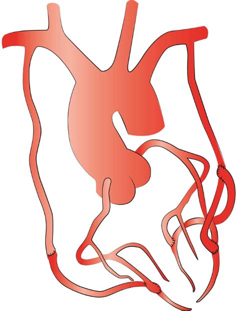 Herz Bypass Operation Herzchirurgie Uniklinik Köln