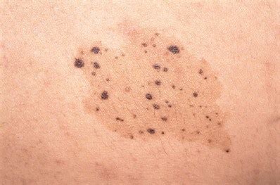 Nevus Spilus Speckled Lentiginous Nevus