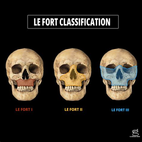 Le Fort Iii Fracture