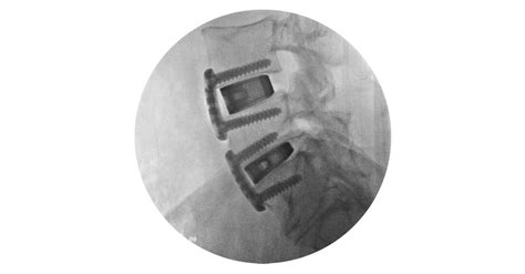 Zavation Introduces 2 Screw Alif Plating System Z Span