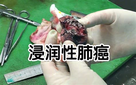 新鲜肺癌又来了！肺组织病变区域是囊实性的，冰冻结果出来是恶性！一起来看看它的形态吧！ 走进病理 走进病理 哔哩哔哩视频