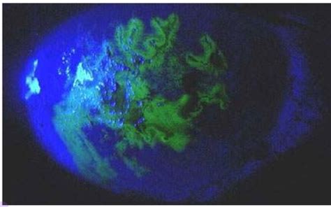 Lecture 5 Corneal Abnormalities Flashcards Quizlet