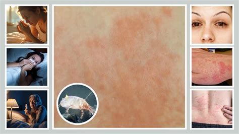 7 Warning Signs Of Dust Mites In Your Bed Bite And Symptom