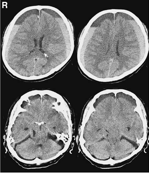 Preoperative Computed Tomography Scans Showing Thick Bilateral Chronic Download Scientific