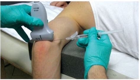 Distal Triceps Tendon Injections Wikism Sports Medicine Wiki