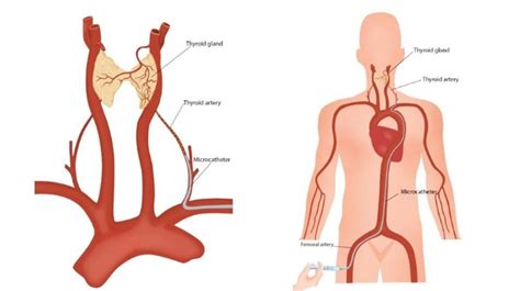 Thyroid Embolization Treatment In Indore Dr Alok Kumar