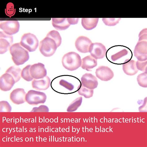 Hemoglobin C Crystals