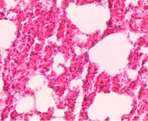 Lung Section Showing Interstitial Pneumonia Hande 40x Download