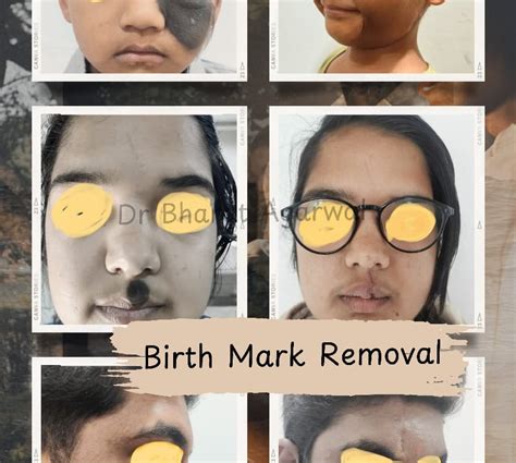 Common Birthmark Like Hairy Black Nevus Causes And Treatment Dr