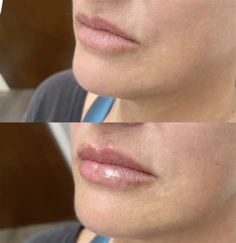 Innerbeauty Med Spa Gallery Injections Hair Removal Body Contouring