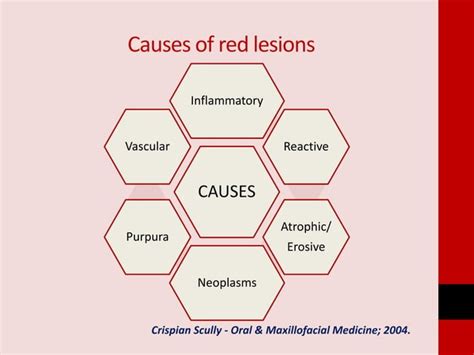 Red And White Lesions Of Oral Cavity Pptx Red And White Lesions Of Oral Cavity Pptx