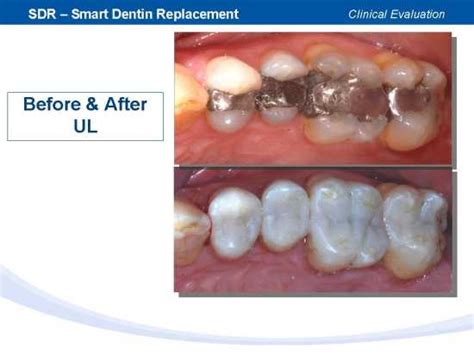Direct Restorations Dentsply Sdr Smart Dentin Replacement Multiple