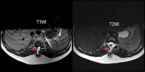 Radiological Evaluation Of Diastematomyelia And Its Associated Anomalies Eurorad