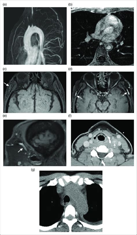 Vascular And Inflammatory Diseases A B Takayasus Arteritis Mr