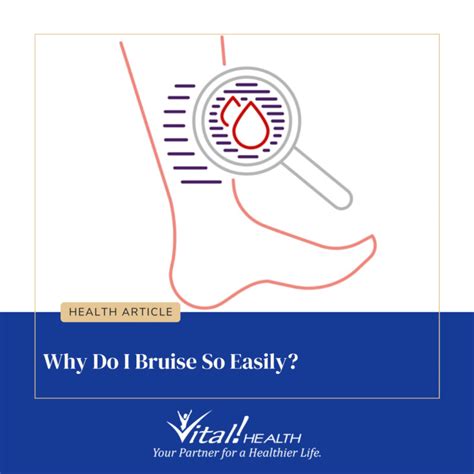 Why Do I Bruise So Easily Vital Health