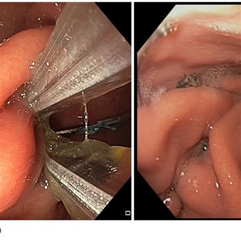 A Endoscopic Sleeve Gastroplasty With The Endomina Suturing System