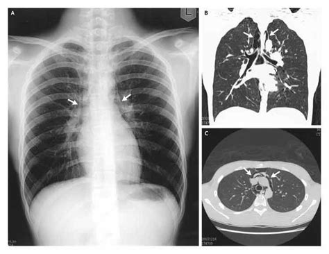 How Do You Approach A Patient With Pneumomediastinum Clinical