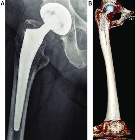 Periprosthetic Femoral Fracture Type B1 A An X Ray Image Of A Download Scientific Diagram