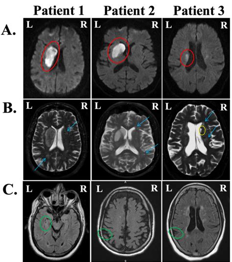 Clinical Images From The Three Patients With Marked Language Deficits Download Scientific