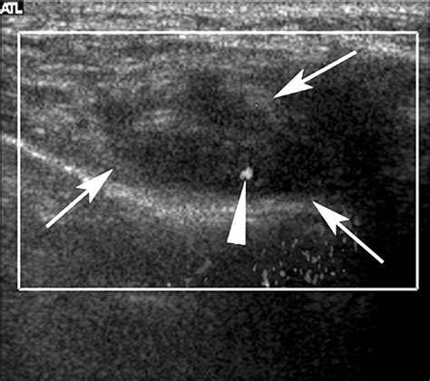 Normal And Abnormal Us Findings At The Mastectomy Siteradiographics