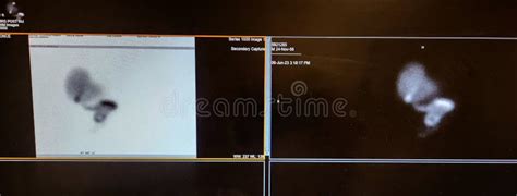 Nm Hida Scan Showing Liver And Normal Gallbladder Filing Editorial Photography Image Of Clinic