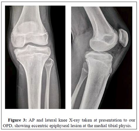 Journal Of Orthopedic Oncology Intraepiphyseal Osteoid Osteoma Of
